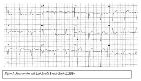 Abnormal Ekg Readings