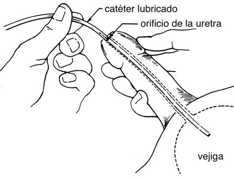 Cateterismo Intermitente