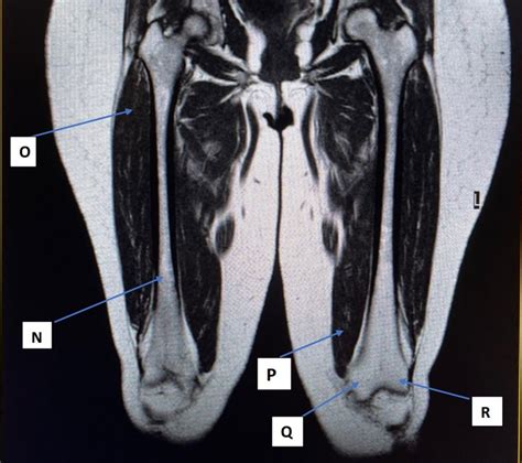 Mri Femur Hip Diagram Quizlet