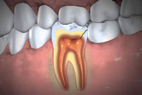 Cómo drenar un absceso dental en casa Urgencias dentales