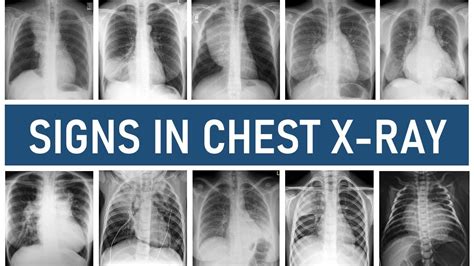 Chest X Ray Signs