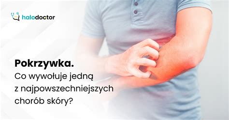 Pokrzywka Przyczyny Objawy I Leczenie