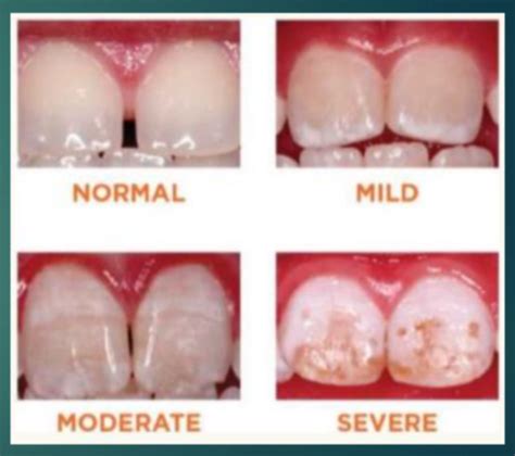 Teeth Abnormalities Flashcards Quizlet