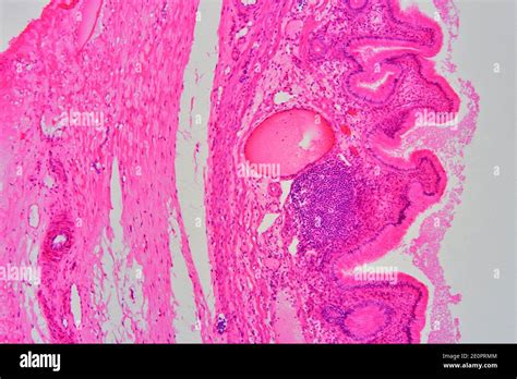 Gallbladder Wall Showing Columnar Epithelium With Mucosal Folds