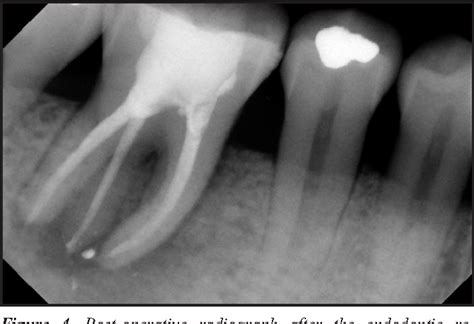 Figure 1 From Endodontic Treatment Failure Consecutive To Unsystematic