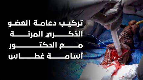 عملية دعامة العضو الذكري المرنة مع دكتور أسامة غطاس YouTube