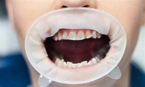 Bump Inside Lip Symptom Causes Treatments Local Dentist