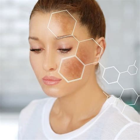 Laser Q Switch para Manchas e Melasma Inove Estética Avançada