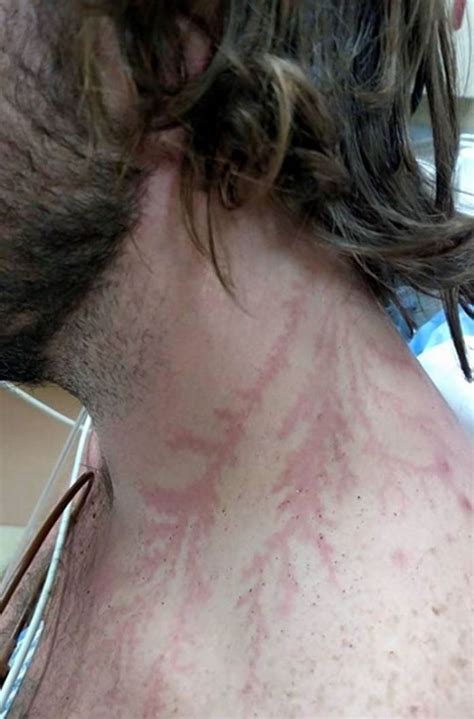 People Who Survived Getting Struck By Lightning Show What It Does To