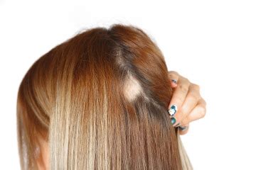How To Stop Alopecia Areata From Spreading Myths Vs Facts