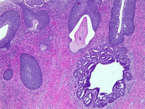 Pathology Outlines Adenocarcinoma In Situ