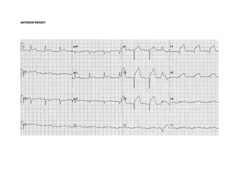 Ecg Mi Revision Notes Anterior Infarct Ecg Changes St Segment