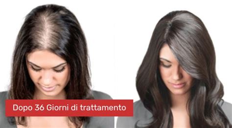 Ricrescita Dei Capelli E Anticaduta Il Metodo Rivoluzionario Scoperto
