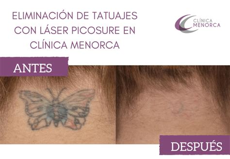 Cómo eliminar un tatuaje para siempre Clínica Menorca