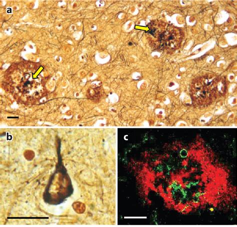 Figure 1 From Amyloid Precursor Protein Processing And Alzheimer S