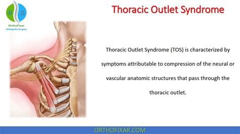 Thoracic Outlet Syndrome Tos Orthofixar