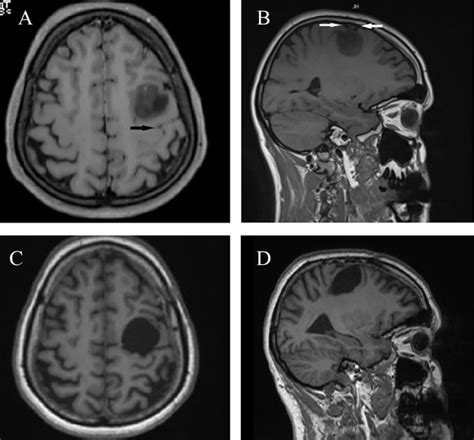 Supplementary Motor Area Mri