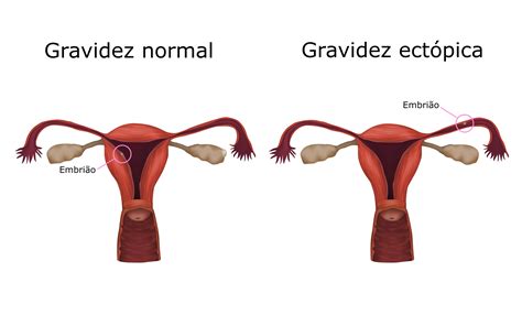 Gravidez ectópica tipos sintomas e tratamento fbautomatico