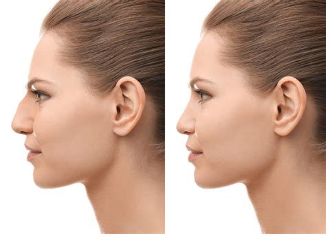 Rhinoplastie Tout Savoir Tout Savoir Sur La Rhinoplastie En Turquie
