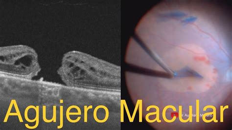 Cirugía de Agujero Macular Flap invertido Dr Aureliano Moreno