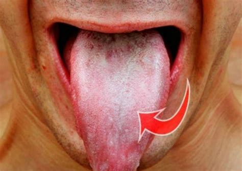 YouTube Qué pasa si tienes manchas blancas en la lengua Alerta