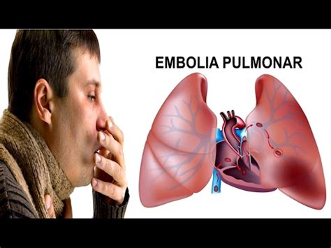 Embolia Pulmonar Sintomas Tratamentos E Causas YouTube