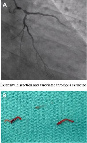 Extensive Spontaneous Coronary Artery Dissection Associated With