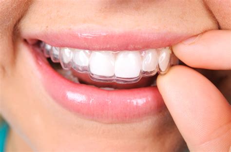 Invisalign u ortodoncia invisible Cómo funciona Clínica Dental GEO