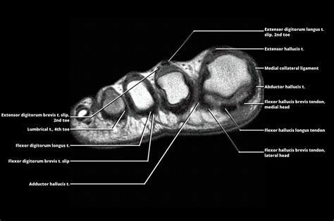 MRI FOOT