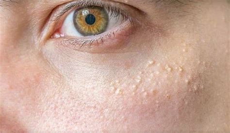 8 remèdes naturels pour se débarrasser des grains de milium