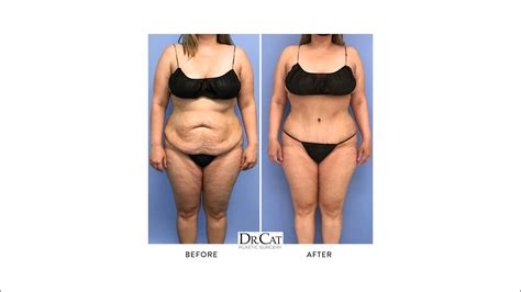 Amazing Transformation After A Tummy Tuck With Pubic Lift And