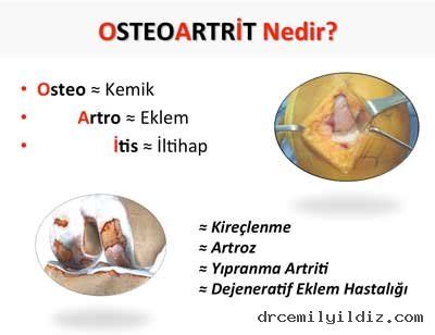 OSTEOARTRİT NEDİR Dr Cemil YILDIZ