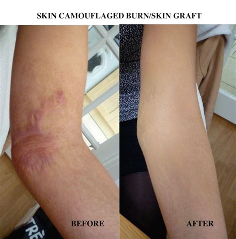 How To Hide Self Injury Scars With Makeup Saubhaya Makeup