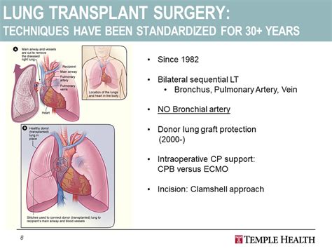 Lung Transplant Surgery Techniques Have Been Standardized For