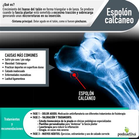 Espolón calcáneo Causas síntomas y tratamientos