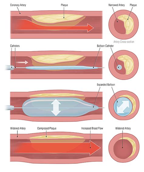 Coronary Artery Disease Cardiovascular