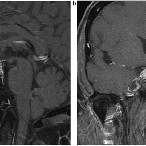 Sagittal Post Contrast T1 Weighted Fat Saturated Image Showing An