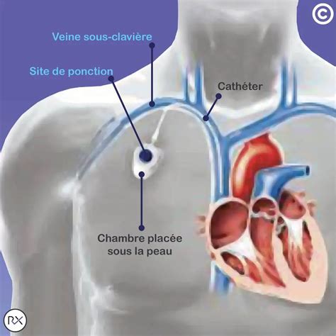 AIGUILLE DE HUBER Pose Et Retrait Keyros Medica