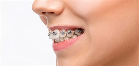 Ortodonti Di Teli Nvisalign Dijident A Z Ve Di Sa L Poliklini I