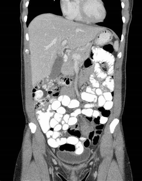 Abdomen Pelvis CT Scan St Elizabeth S Medical Center Steward