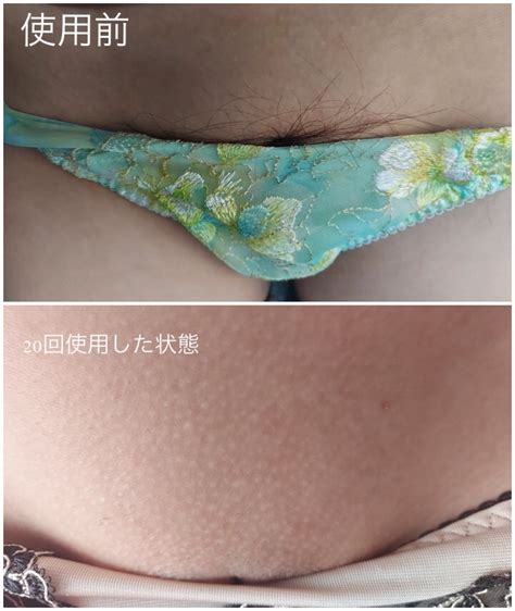 ケノンでvio脱毛【写真あり】女のアンダーヘアの脱毛経過を公開！ Nurse Hack