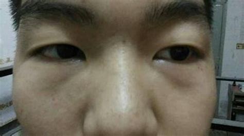 逐渐出现特征性的肝病面容图片 有来医生
