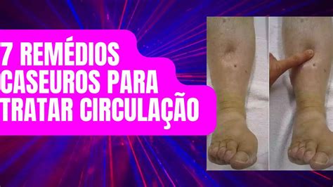 7 Remédios Caseiros Para Curar Má Circulação Nas Pernas