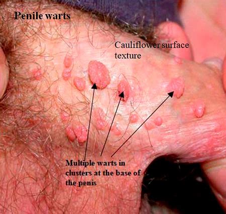 Genital And Common Warts Pictures On Various Parts Of The Body