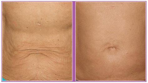 Radio Frequency Skin Tightening Training Montreal Reimagine Clinic