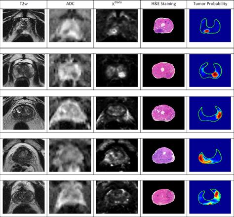 Magnetic Resonance Imaging For Prostate Cancer Radiotherapy Physica Medica European Journal