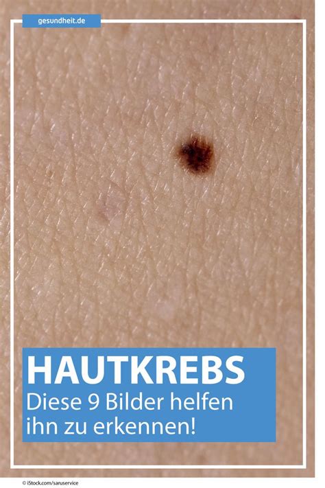 Hautkrebs An Bildern Erkennen Hautkrebs Hautkrebs Bilder Schwarzer