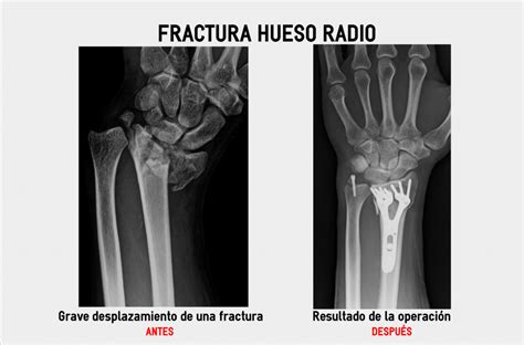 El radio es el hueso que más se rompe señales y tratamientos