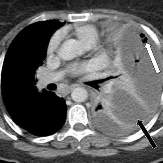 Axial Computed Tomography Scan Showing Mild Left Pleural Effusion