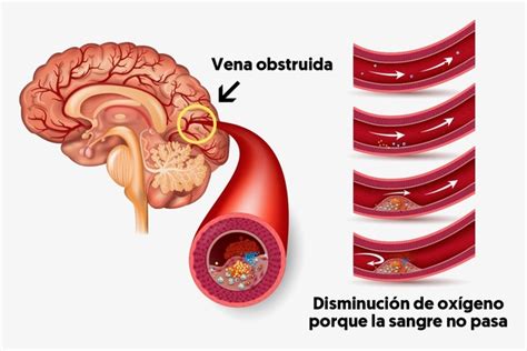 Las 7 consecuencias más comunes de un derrame cerebral Maestria Salud